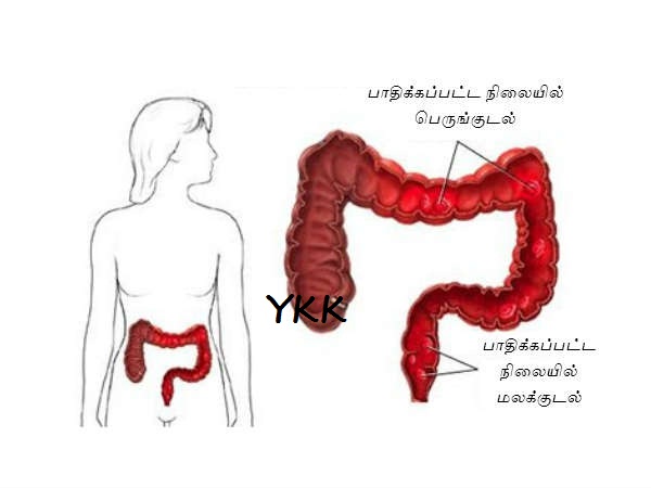 பெருங்குடல் பாதிப்பை வெளிப்படுத்தும் அறிகுறிகள் | WWW.YOURKATTANKUDY.COM